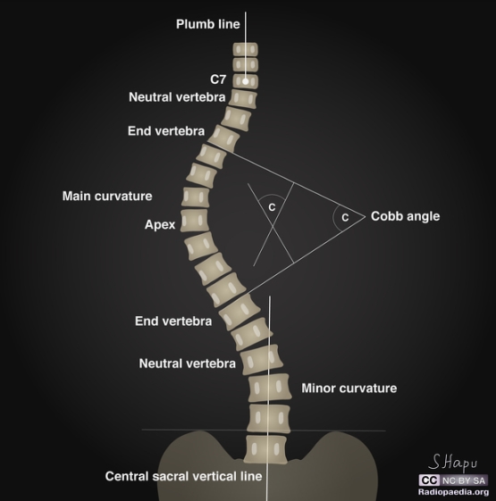 Cobb's angle(콥스각)과 국소 후만각(local kyphotic angle) : 네이버 블로그