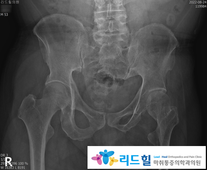 엉덩이 부위 통증 좌골돌기 윤활낭염 Vs 허리디스크 네이버 블로그