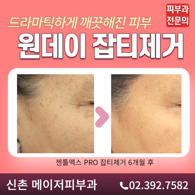 신촌 피부과 잡티제거 주근깨레이저 기미레이저토닝 검버섯레이저 주근깨제거 기미 검버섯제거 점빼기 흑자제거 가격 효과 비용 이벤트