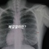 고립성 폐결절 증상 및 폐기능 저하 검사 네이버 블로그