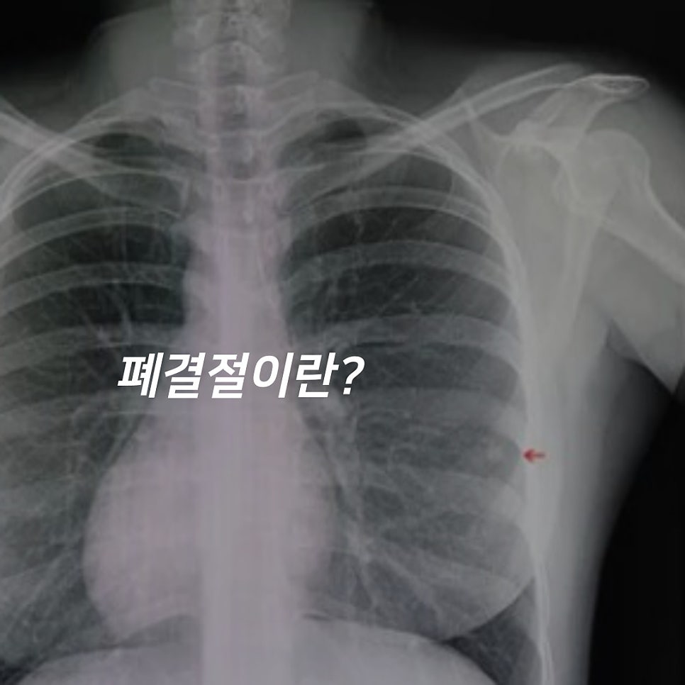 고립성 폐결절 증상 및 폐기능 저하 검사 네이버 블로그