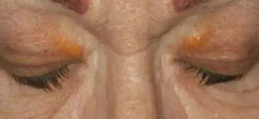 헷갈리는 피부 병변에 관련한 용어의 뜻 정리 네이버 블로그