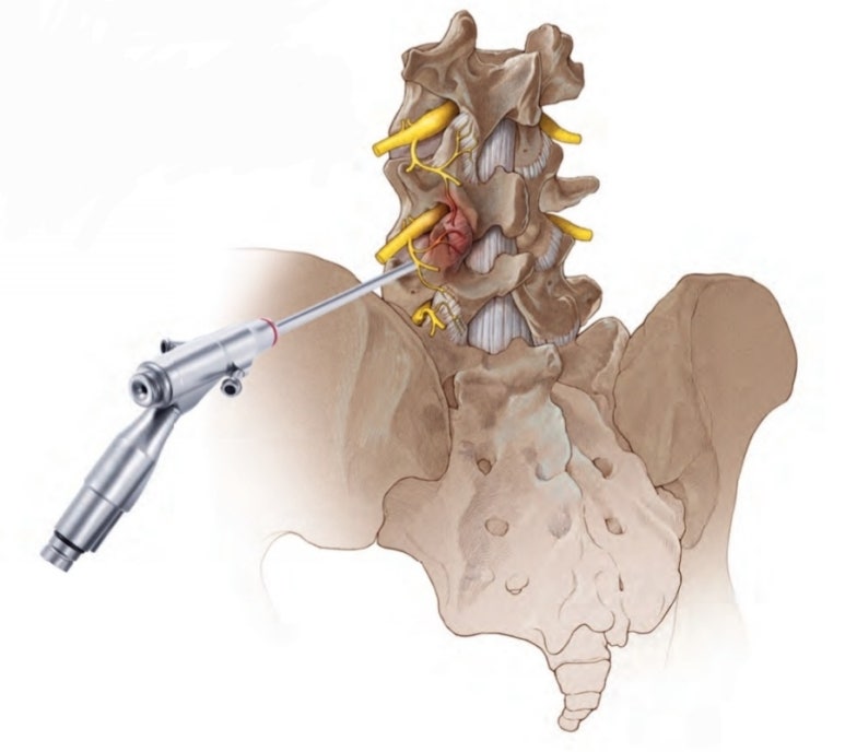 [NS수술] PELD(Percutaneous Endoscopic Lumbar Discectomy, 경피적 내시경 추간판 절제술 ...
