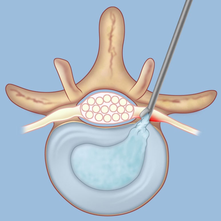 [NS수술] MLD(Microscopic Lumbar Discectomy, 미세현미경 추간판 절제술) : 네이버 블로그