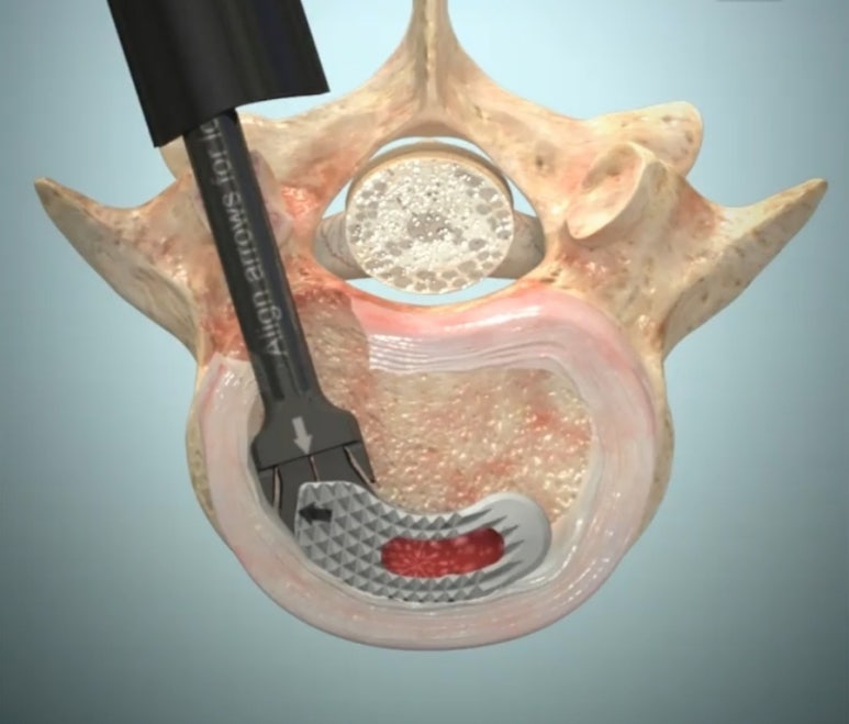 [NS수술] TLIF(Transforaminal Lumbar Interbody Fusion, 경추간공 요추 추체간 유합술 ...