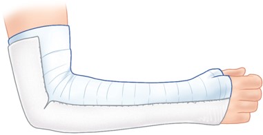 정형외과 :: 정형외과 Splint, Cast 종류 : 네이버 블로그