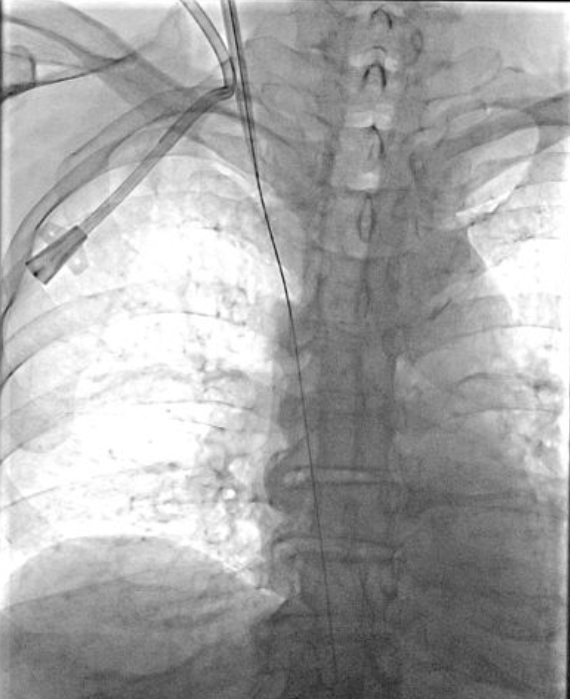 Perm catheter Procedure(터널식 투석도관 삽입술)-장기목적용 : 네이버 블로그