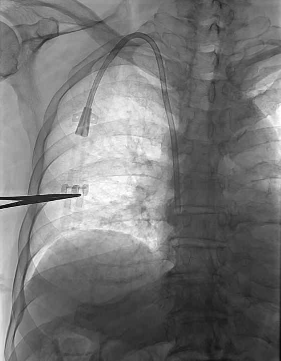 Perm catheter Procedure(터널식 투석도관 삽입술)-장기목적용 : 네이버 블로그