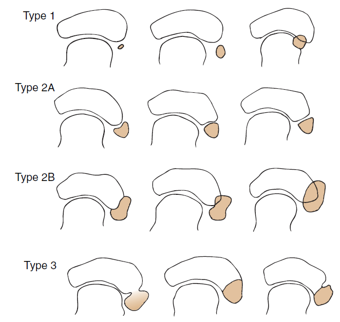 부주상골 증후군(ANS, Accessory Navicular Syndrome, prehallux syndrome) : 네이버 블로그