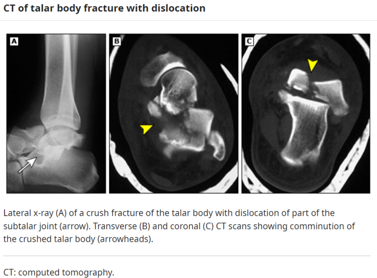 Talus fracture (거골 골절) : 네이버 블로그