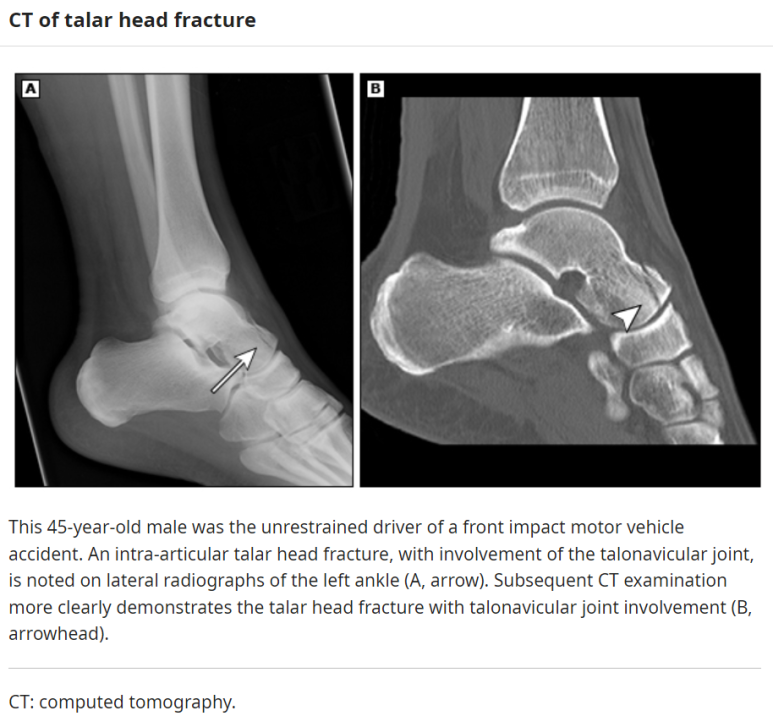 Talus Fracture 거골 골절 네이버 블로그