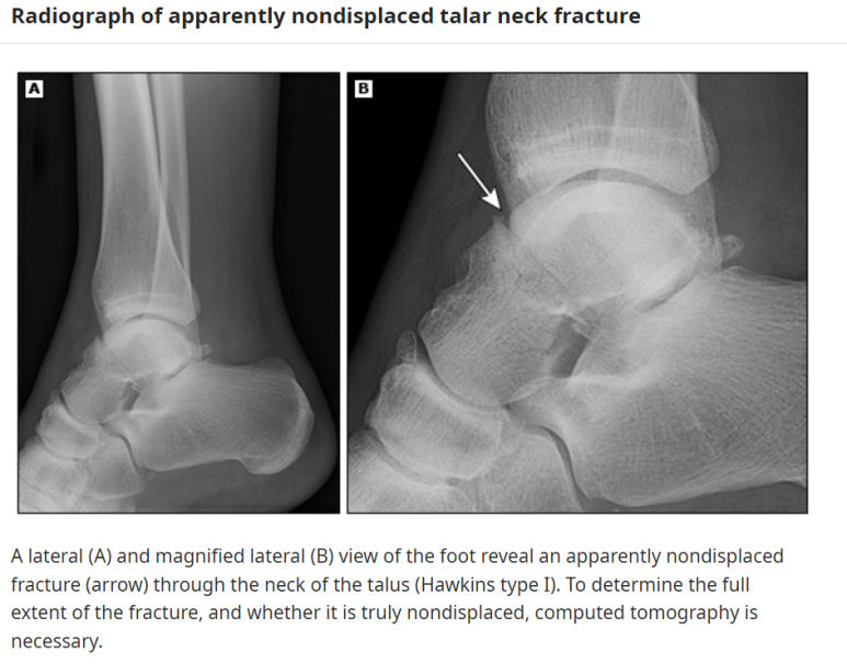 Talus Fracture 거골 골절 네이버 블로그