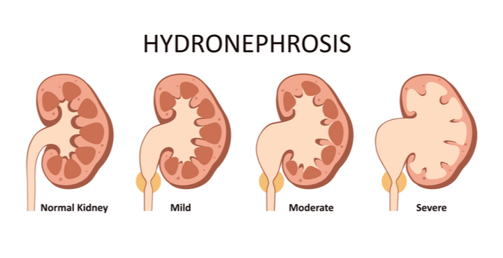 수신증 (Hydronephrosis) : 네이버 블로그