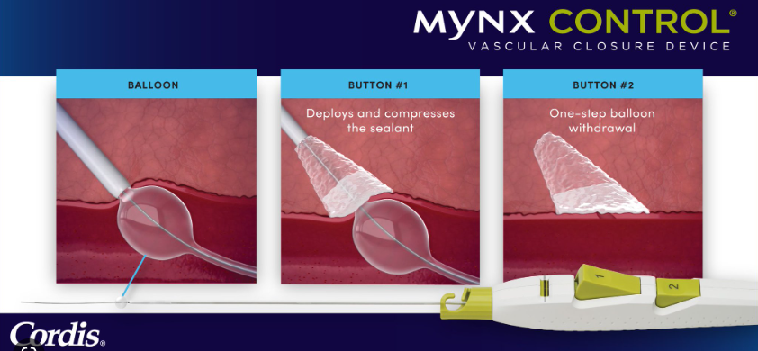 혈관폐쇄기구의 사용방법 4th- Mynx Control vascular Closure device : 네이버 블로그