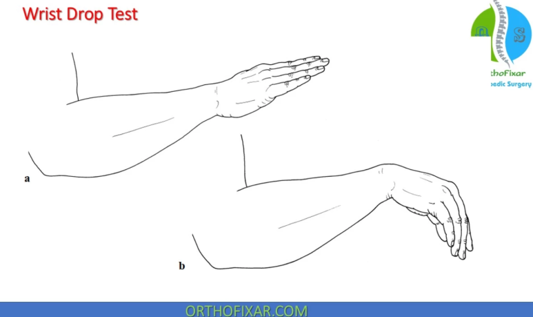 Wrist drop, Radial nerve palsy (요골 신경 마비) : 네이버 블로그