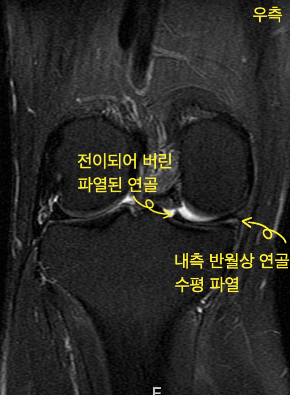 3년된 반월상 연골 수평 파열meniscus Horizontal Tear 40대 초반 초음파로 진단 후 주사치료로