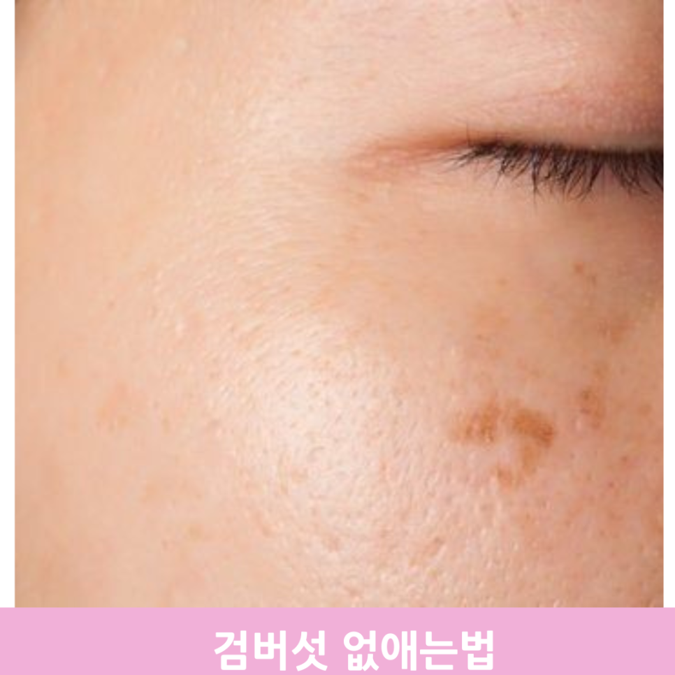 얼굴 손등 검버섯 없애는법 원인 및 케어 방법 네이버 블로그