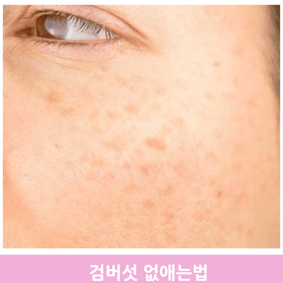 얼굴 손등 검버섯 없애는법 원인 및 케어 방법 네이버 블로그