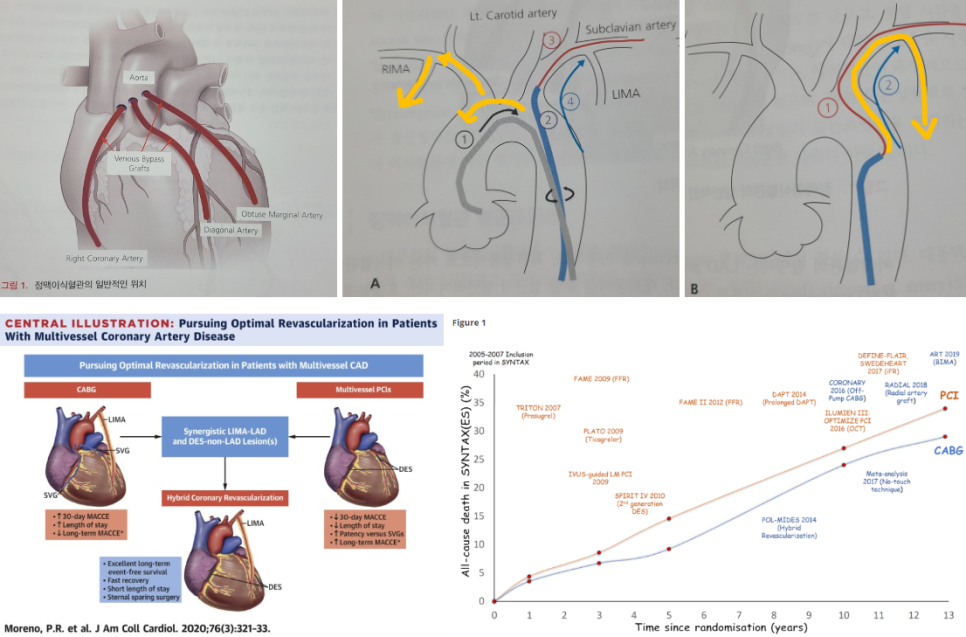 CABG(이식혈관)혈관 정맥이식혈관, 내흉동맥(Saphenous/RIMA/LIMA) 혈관조영술(PCI in Graft ...