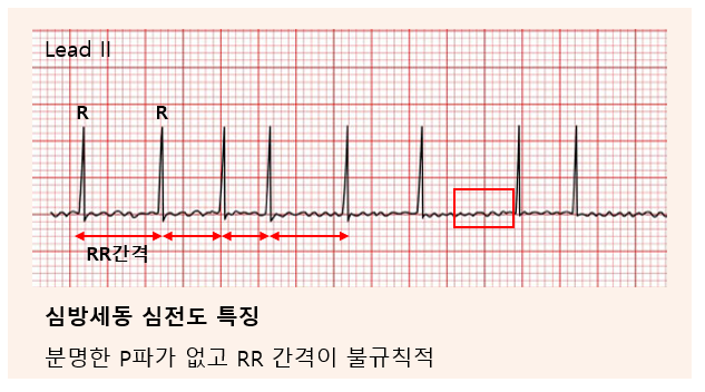 심방세동 총정리 atrial fibrillation, 의학용어 AF, Afib, Paroxysmal, Persistent 정의 ...