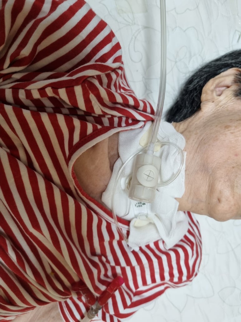 T-tube 교체, 드레싱 및 내관 소독 관리 ( tracheostomy tube care) & PEG : 네이버 블로그