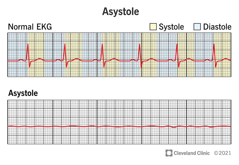 Asystole, PEA 차이에 대해서 알아보자. : 네이버 블로그