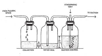 CTD : Chest Tube Drainage의 bottle 이해하기, Chest Bottle A Type-C type, CTD ...
