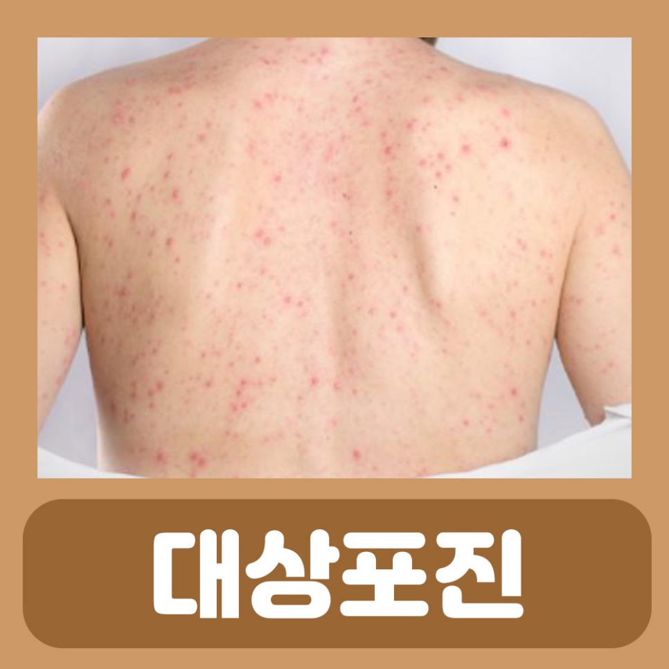대상포진 치료 약 초기증상 눈 엉덩이 얼굴 대상포진 증상 원인 전염성 예방접종 백신 얼굴 피부 물집 네이버 블로그