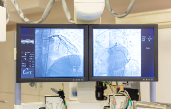 의학용어 PTA PTCA 관상동맥질환 관상동맥 스텐트 경피적 풍선확장술 : 네이버 블로그