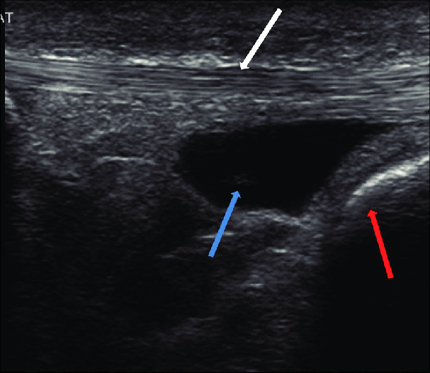 슬개골 아래가 아파요 - 슬개하점액낭염(Infrapatellar bursitis, Clergyman's knee) #청담동한의원 ...