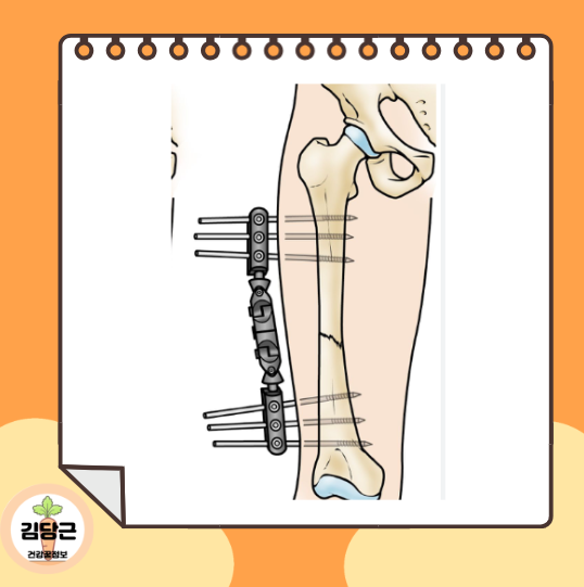 의학용어 ORIF CRIF 뜻과 치료방법의 차이점 알아보기 : 네이버 블로그