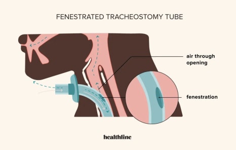 기관절개술(Tracheostomy) 및 T-tube 종류 : 네이버 블로그