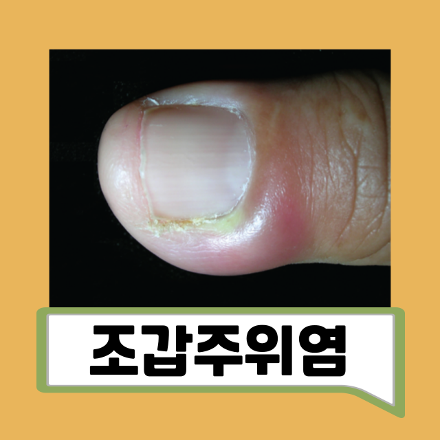 조갑주위염 연고 손톱 발톱 옆 염증 고름 생손앓이 자가치료 네이버 블로그