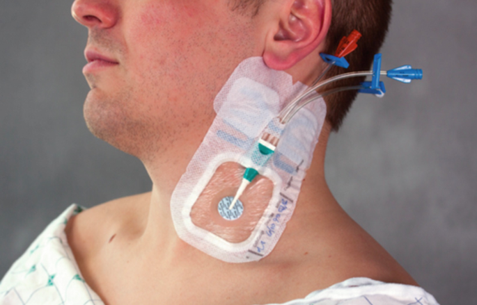 중심정맥관 삽관 부위, 내경정맥(Internal Jugular vein) Jugular catheter : 네이버 블로그