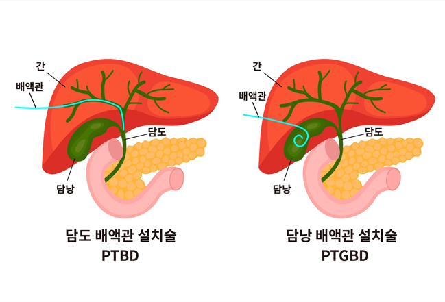 [소화기] ERCP, ENBD, ERBD, EST, PTBD, PTGBD 정리 : 네이버 블로그