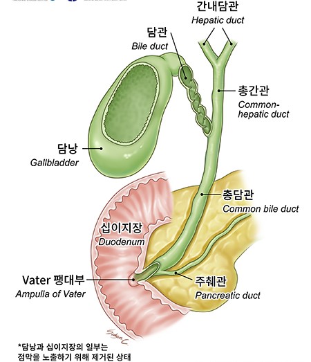 [소화기] ERCP, ENBD, ERBD, EST, PTBD, PTGBD 정리 : 네이버 블로그