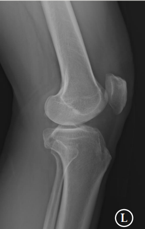 Knee AP,PA,ROSENBERG(Both Lat, Merchant)촬영법 무릎관절 X-RAY검사법 소개 : 네이버 블로그