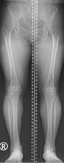 WHOLE SPINE AP,PA, LAT 촬영방법 소개(LONG BONE ) : 네이버 블로그