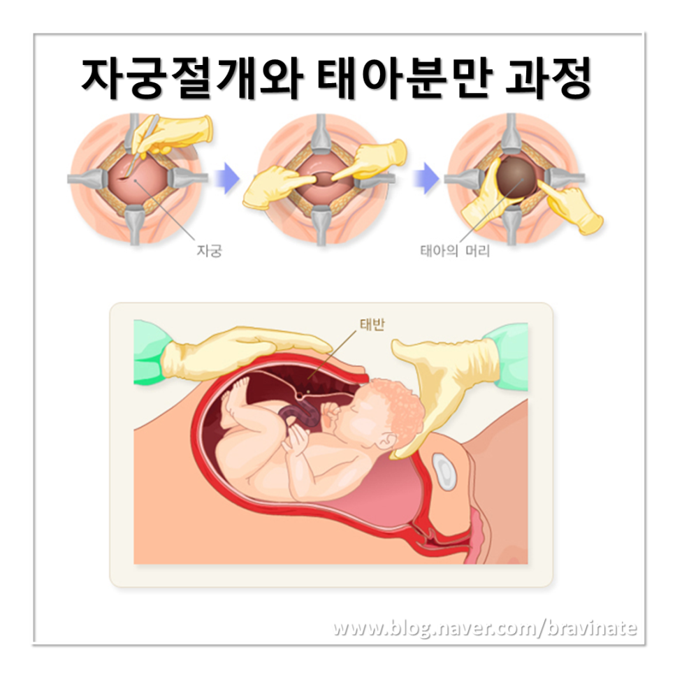 제왕절개술 수술 방법 합병증 부작용 회복 흉터 통증 가스 자연분만 마취 단점 뜻 네이버 블로그