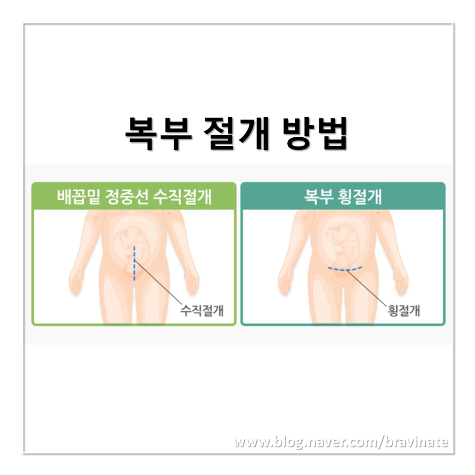 제왕절개술 수술 방법 합병증 부작용 회복 흉터 통증 가스 자연분만 마취 단점 뜻 네이버 블로그