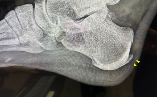 미아역한의원 발뒤꿈치 통증 아킬레스건 통증(haglund deformity 헤그란드 변형) : 네이버 블로그