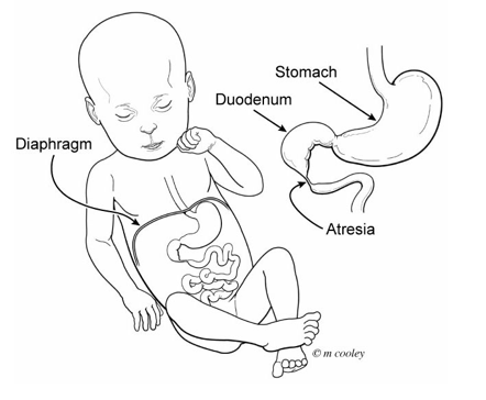 십이지장 폐쇄; Duodenal atresia : 네이버 블로그