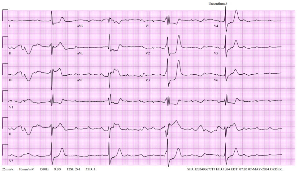 inferior infarction + AV block이 갖는 의미 : 네이버 블로그