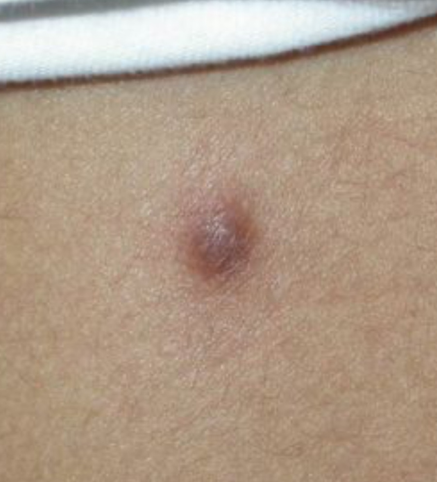 pilomatricoma(모기질종)이란? : 네이버 블로그