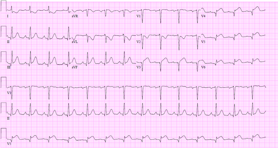 inferior infarction + AV block이 갖는 의미 : 네이버 블로그