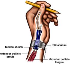 1. APL/EPB syndrome : De Quervain's disease : 네이버 블로그