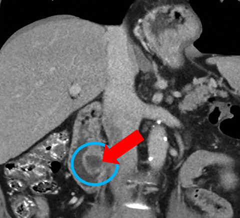 Case_Study_495:이틀 동안 악화된 복통을 호소하며 내원한 67세 남성_ 십이지장 내낭(Intramural ...
