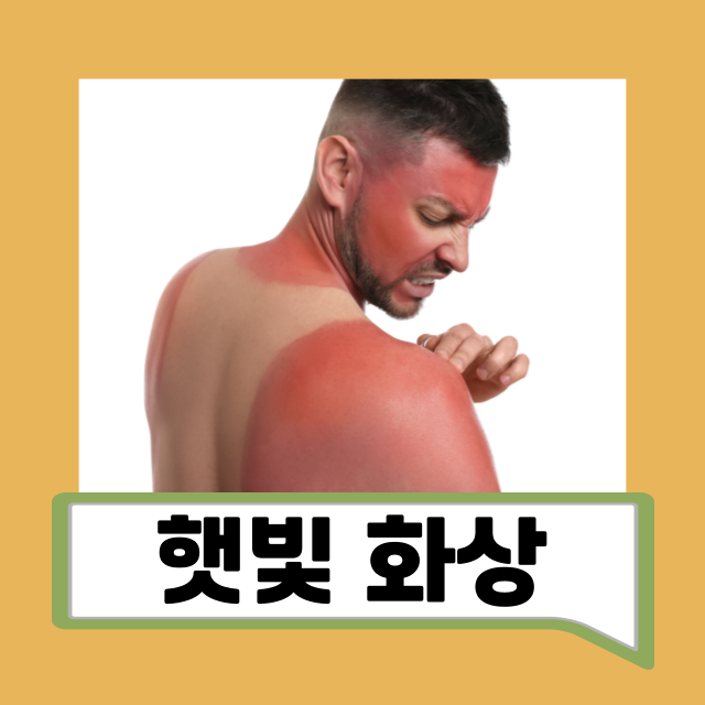 피부햇빛화상 응급처치 일광화상 연고 비판텐 알로에 사용 꿀팁 네이버 블로그