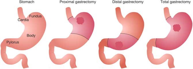 [OR] 위 절제술의 종류(gastrectomy) : 네이버 블로그