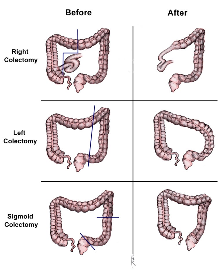 [OR] 대장절제술(colectomy)의 종류 : 네이버 블로그
